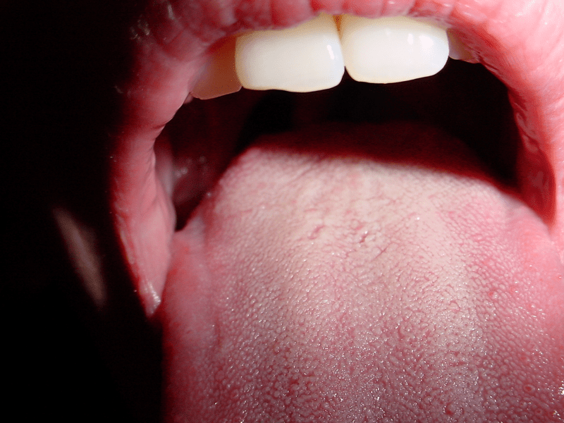 Your Taste Buds What Causes Swollen Taste Buds? Video