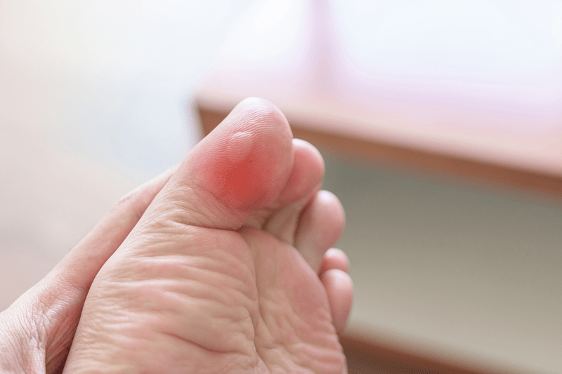 Foot Blisters