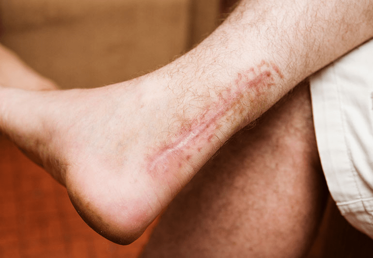 Scars From Cutting Yourself