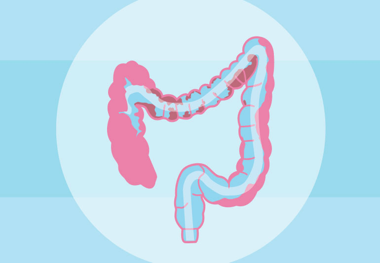 Colon Hydrotherapy Waste