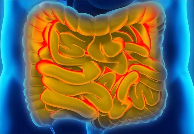 Understanding and Treating Inflammatory Bowel Disease’s Extra ...