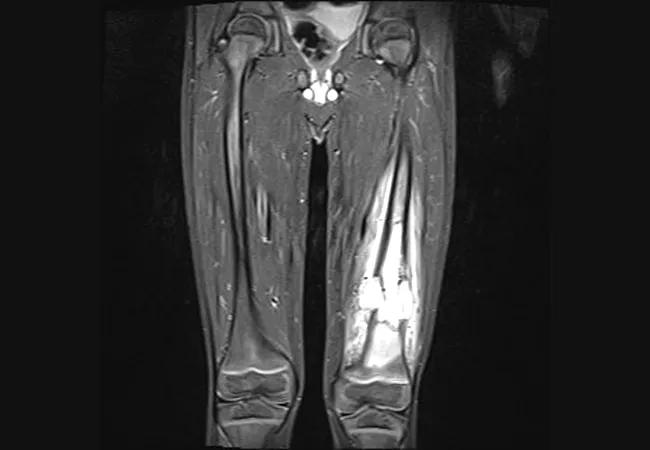 Osteosarcoma Knee Mri