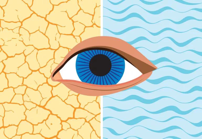 Wet Vs Dry Macular Degeneration