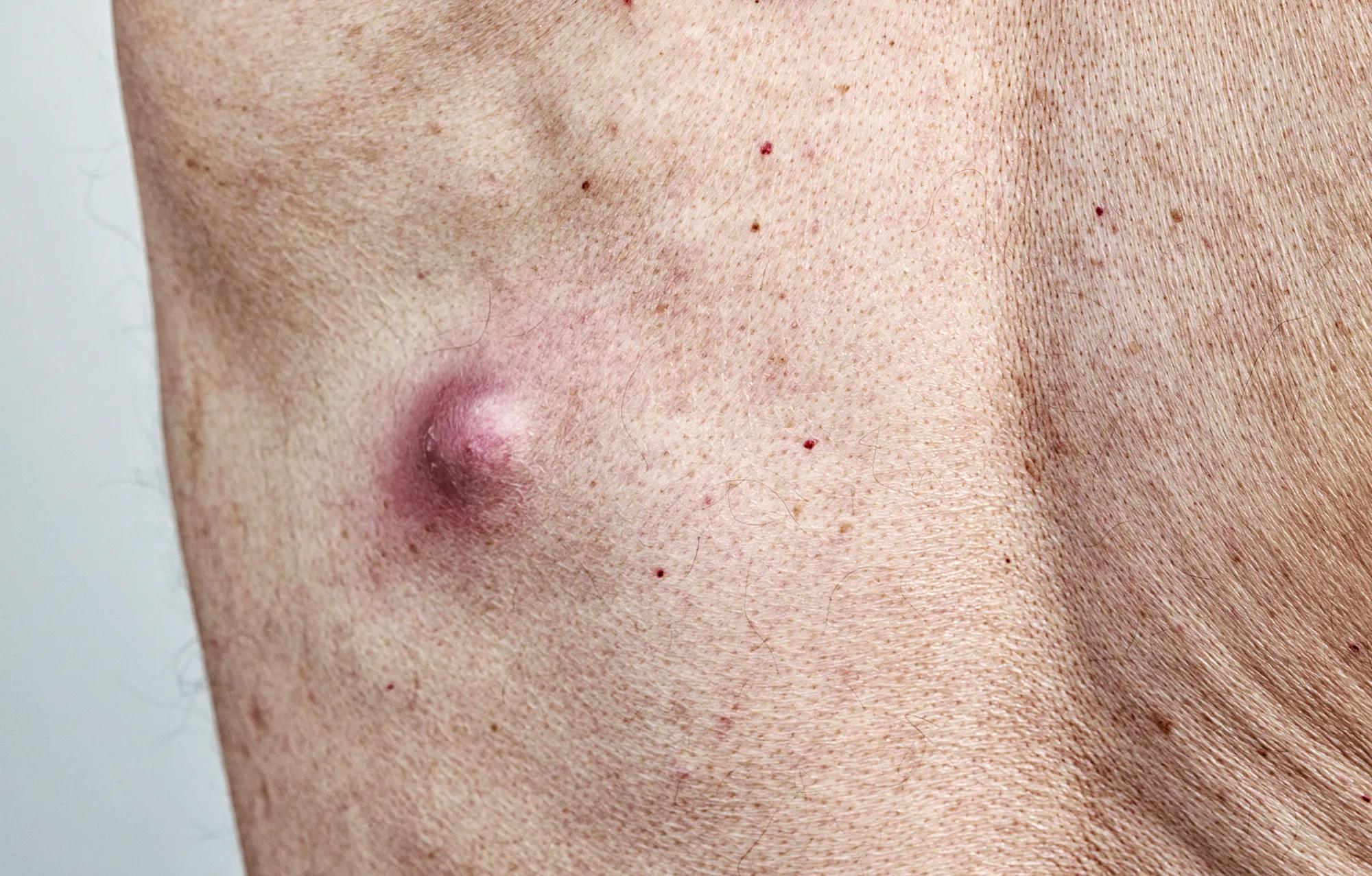 Nodule Pimple On Back