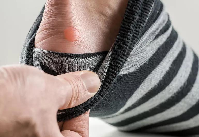 5 Ways to Avoid Blisters and the Best Way to Treat Them