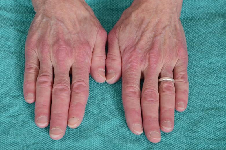 Case Report: Dermatomyositis and Malignancy
