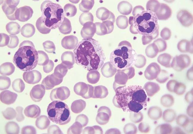 Sindrome Del Diamante Di Shwachman Melissa Joan Hart | Today Is