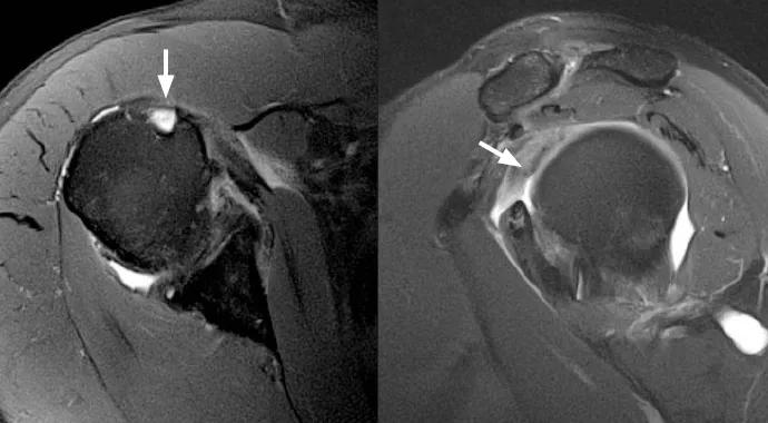 Distal Bicep Tendon Mri