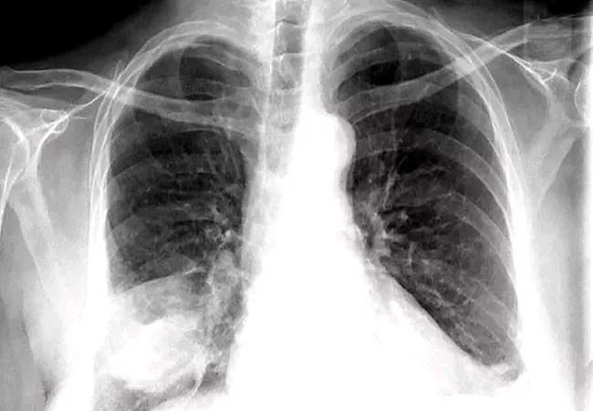 Pneumonia Repurposed Drug Improves Outcomes For Patients With Severe