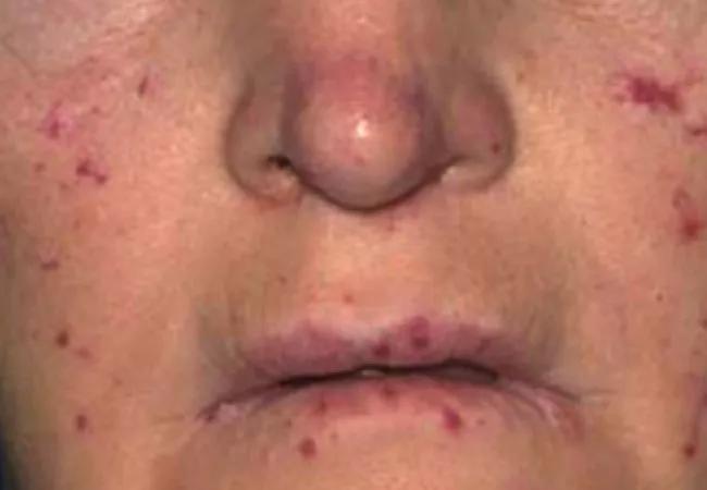 Telangiectasias Nose