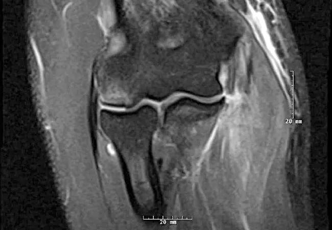Ulnar Collateral Ligament Mri Elbow MRI 1 (Lateral Ulnar Collateral