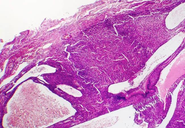 Total Neoadjuvant Therapy with Nonoperative Management in Rectal Cancer
