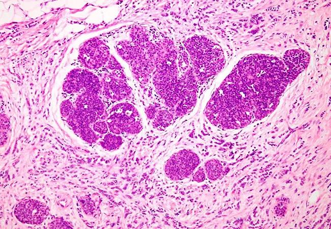 Invasive Lobular Carcinoma Invasive Lobular Carcinoma Mimicking