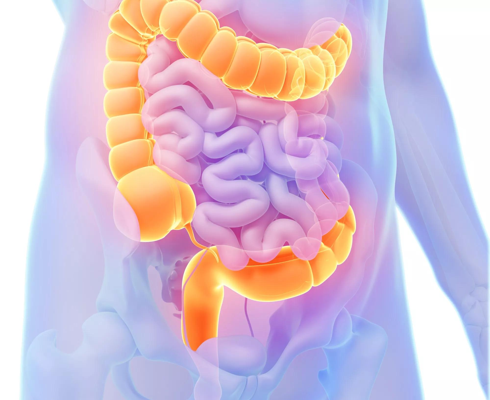 Online Survey Finds Colorectal Cancer Reported More Commonly in ...