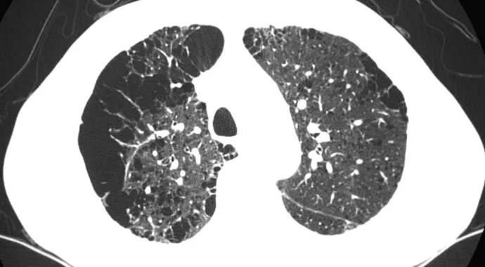 Lung Cancer Cat Scan