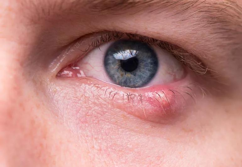 How To Get Rid of That Pesky Stye