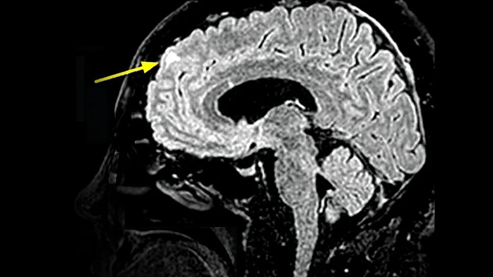 Tuberous Sclerosis Brain