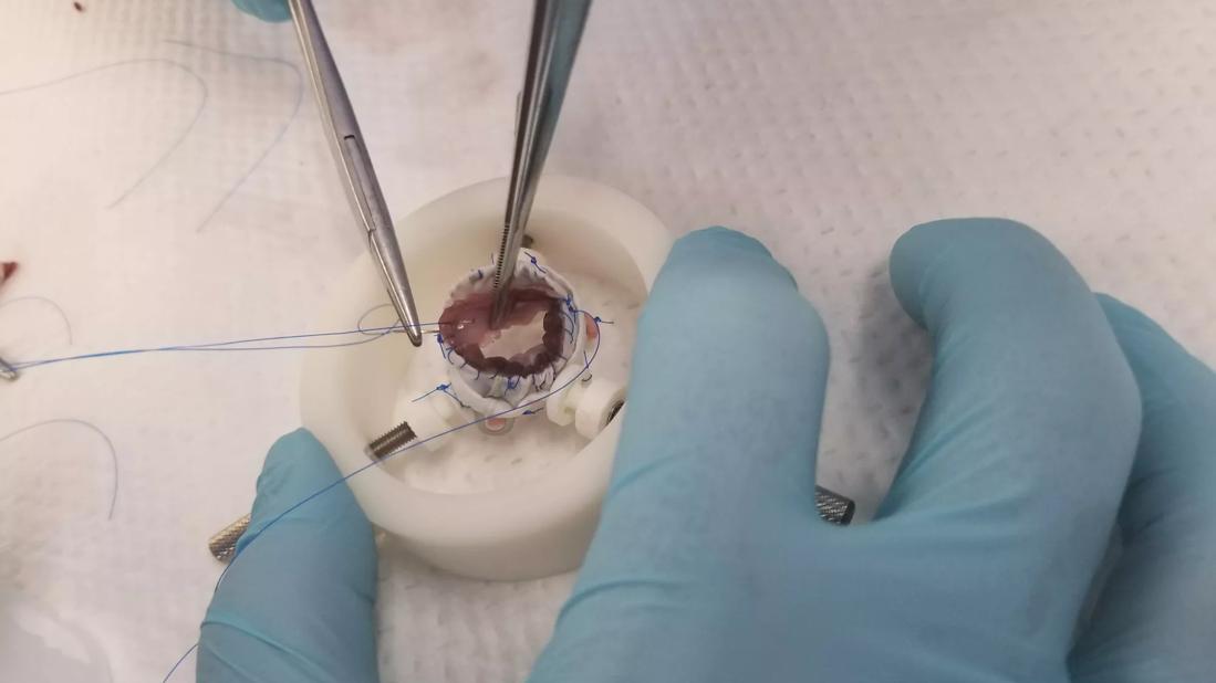 Stented Pulmonary Autograft Promises First Custom Treatment Option for ...