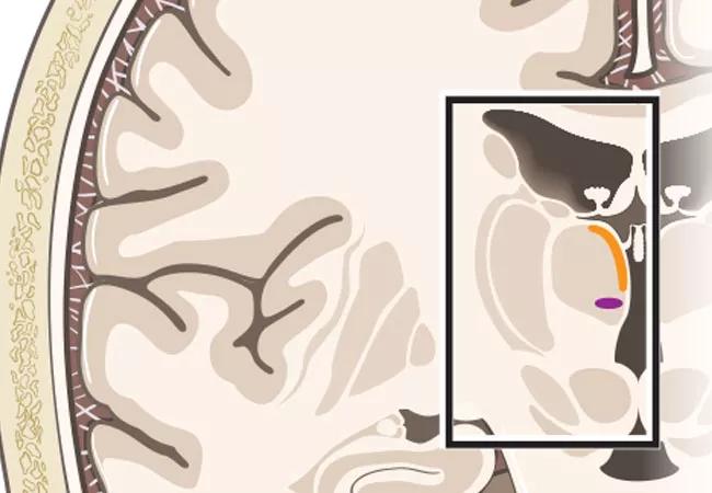 Deep Gray Matter Injury in Multiple Sclerosis: What We Know, Why It Matters