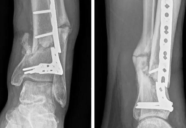 Reconstructing Nonunions of the Distal Tibia