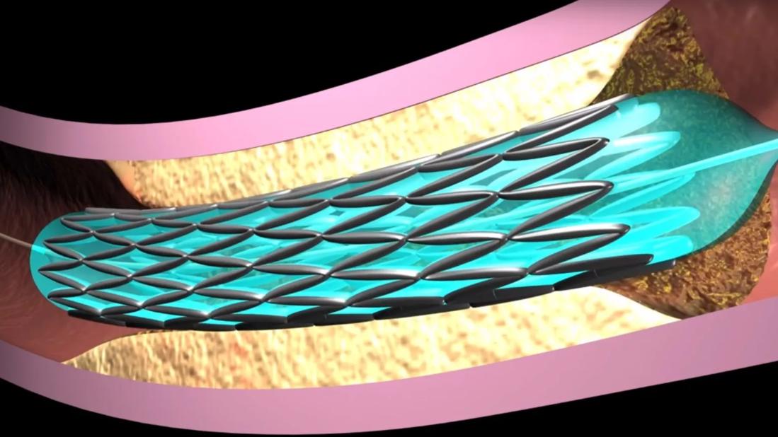 Two Year Data Presented at the American College of Cardiology ...