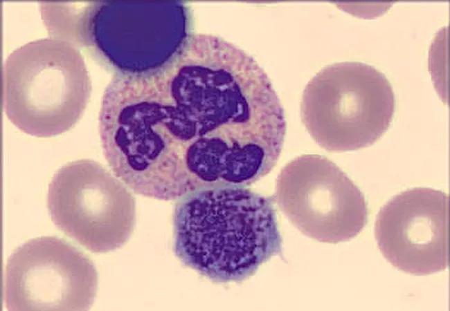 An Improbable Aortic Surgery in the Setting of Giant Platelet Disorder