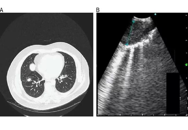 Diagnosing Intrapulmonary Lesions: Utility of Endobronchial Ultrasound ...