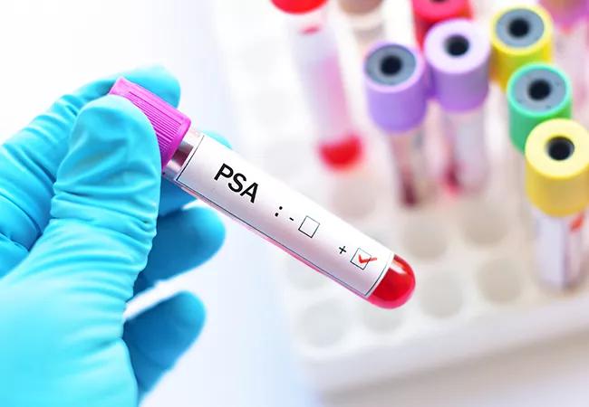 Real-World Study Supports IsoPSA as a Prostate Cancer Biomarker