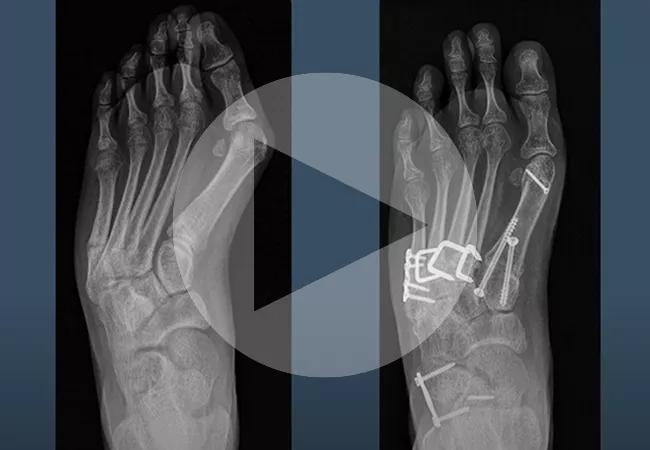 Case Study: Recurring Metatarsal Fracture Indicates Underlying Foot ...