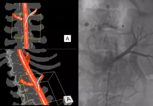 First Case Completed in Feasibility Study of Non-Radiation-Based EVAR ...