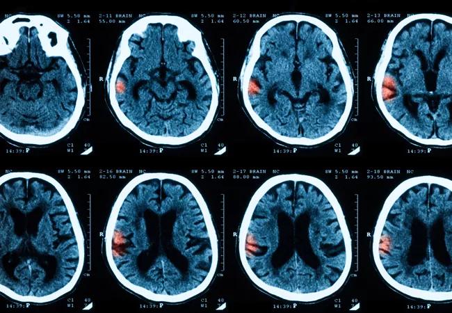 PACNS or RCVS? Differences in Imaging and Test Results