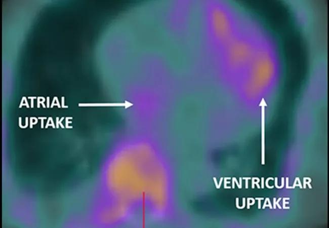 Atrial Uptake on Cardiac Scintigraphy With 99mTc-PyP Signals Greater ...