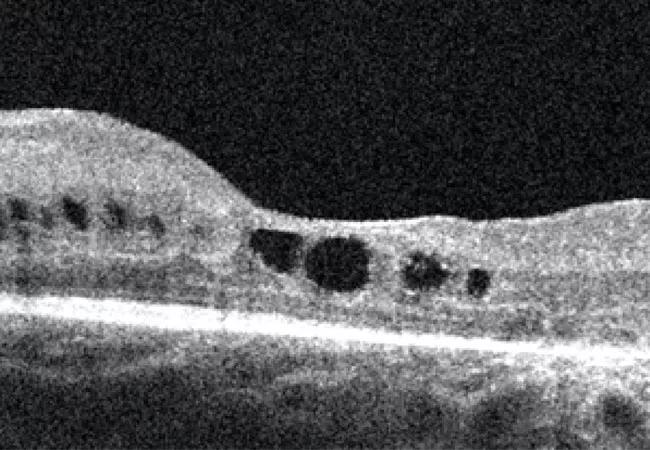 CRB1-Related Retinal Diagnoses on the Rise