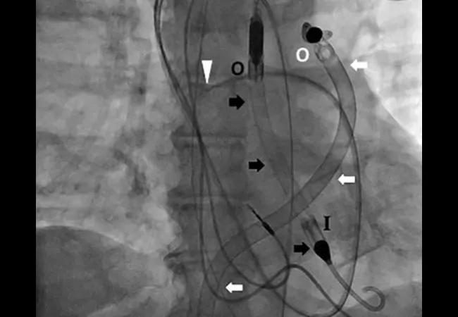 First Successful Use of Biventricular Impella Pumps as a Bridge to ...