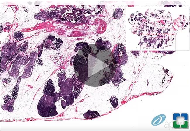 Basics of Thymic Pathology in 6 Minutes (Video)