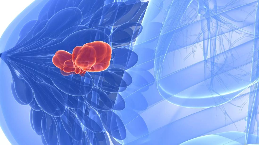 New Breast Cancer Study Finds Survival Increases When Time Between ...