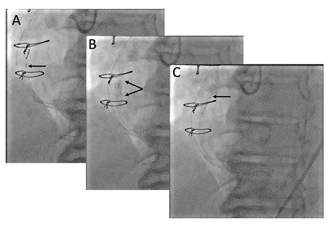 Carlino Technique for High-Complexity CTOs