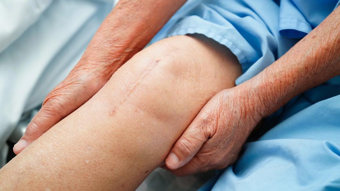 What Happens During a Total Knee Replacement?