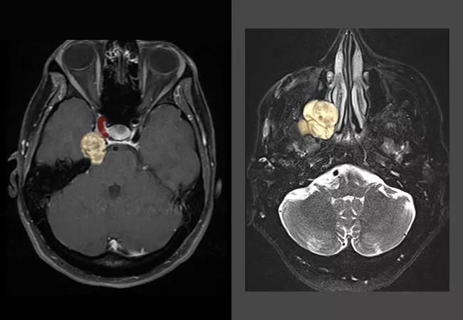 Trigeminal Schwannoma: Two Surgical Options for Two Distinct Cases