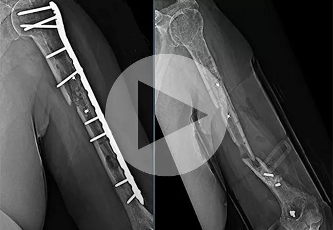 Vascularized Fibular Graft for Persistent Humeral Nonunion