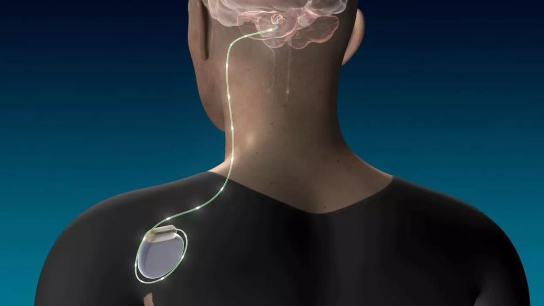 Cleveland Clinic Study Shows Deep Brain Stimulation Encouraging for ...