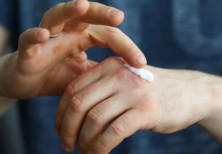 Eczema Flare-Ups Causes and How To Prevent Them