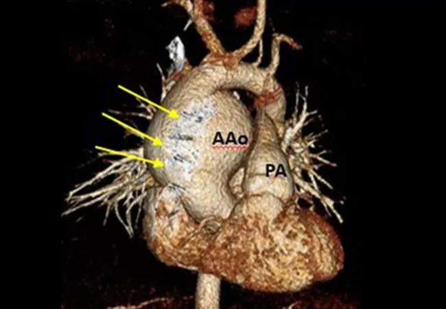 Asymptomatic Aortic Dissection After Orthotopic Heart Transplantation ...