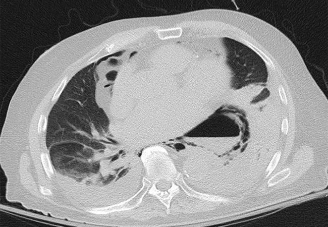 Esophageal Perforation: Effective Options Exist for Even the Most ...