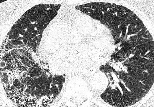 A Paradigm Shift in the Treatment of Scleroderma-Associated ...
