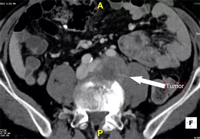 Massive Spine and Retroperitoneal Sarcoma: A Case Study in Surgical ...
