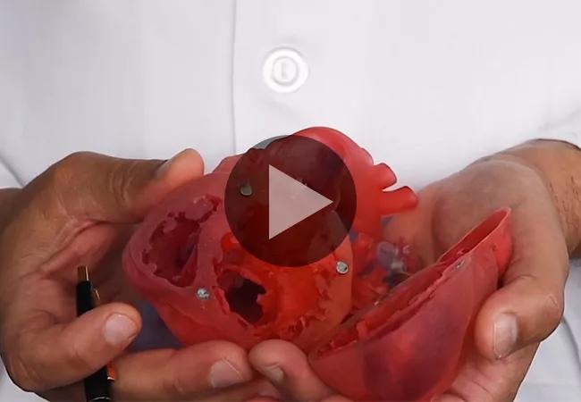 How a 3-D-Printed Heart Replica Helped Plan a Double Switch Procedure ...