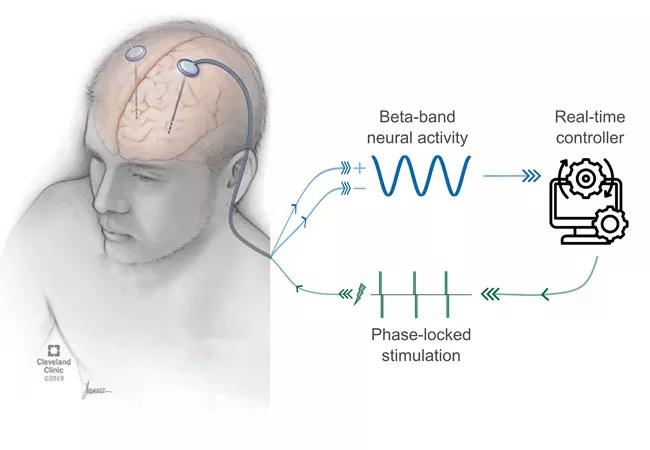 Probing the Neural Mechanisms of Parkinson’s Disease Motor Dysfunction