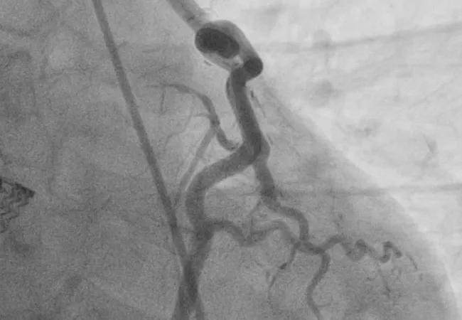 The Ross Procedure in a Reoperative Setting: A Case Study