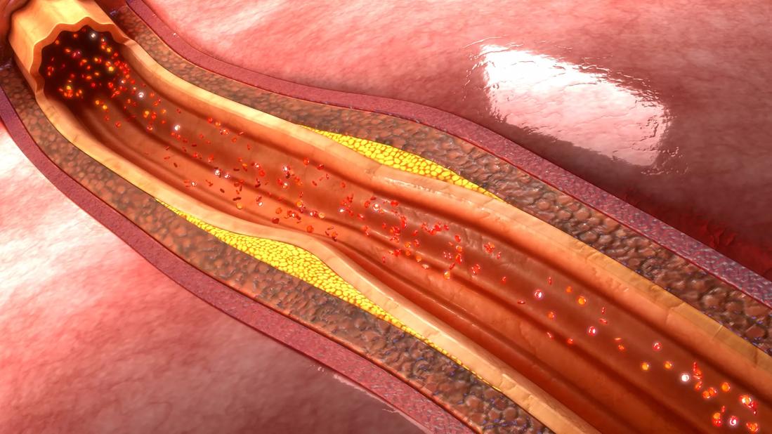 Cleveland Clinic-Led Study Shows Reversal of Coronary Plaque Buildup ...